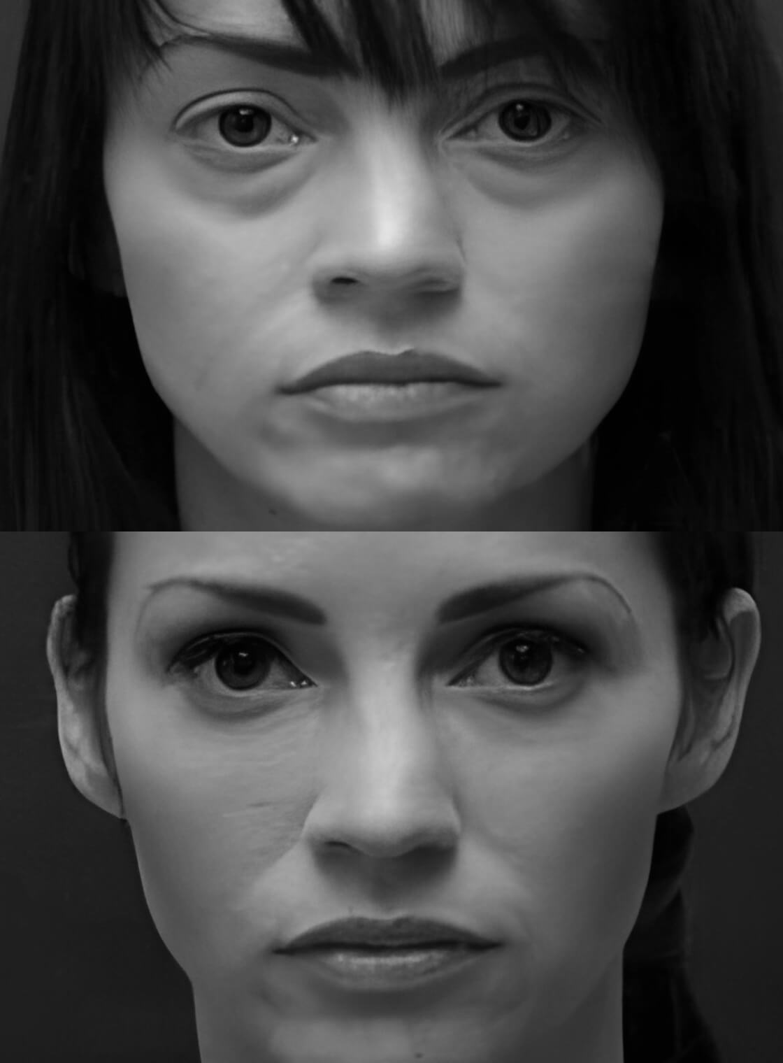 Botox Dysport Before and After Photos Avon - Plastic Surgery Gallery ...