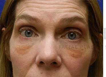 Festoon Treatment Hartford, CT | Dr. Paul Stanislaw