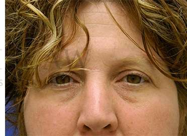 Benign Lesions Hartford, CT | Dr. Paul Stanislaw