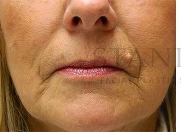 Benign Lesions Hartford, CT | Dr. Paul Stanislaw
