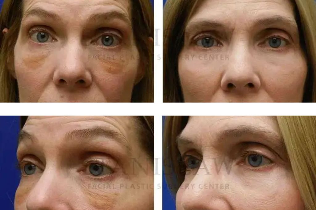 Festoon Treatment Hartford, CT | Dr. Paul Stanislaw